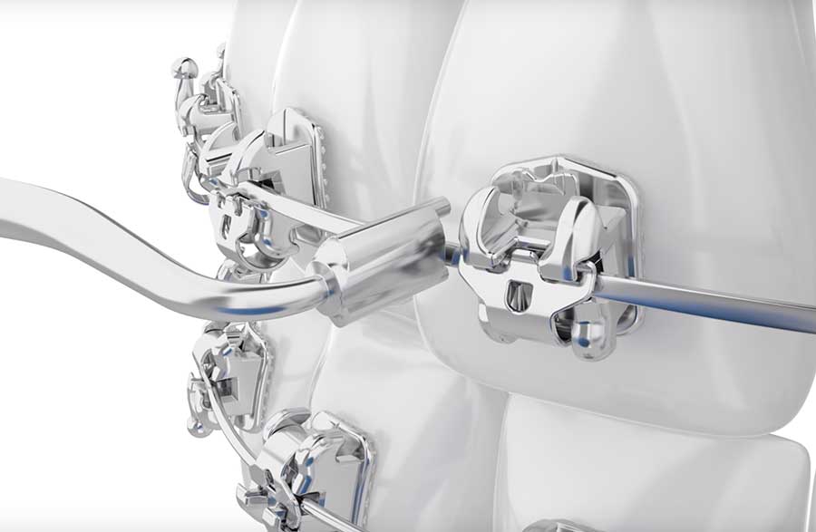 Braces San Francisco CA | Cucalon and Matin Orthodontics